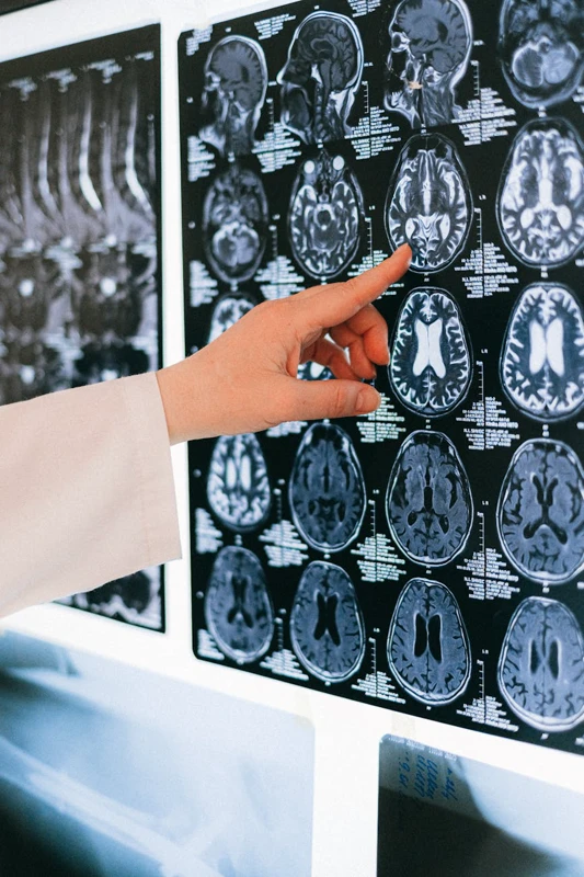 Ingat Golden Period Stroke: Penanganan di Bawah 4,5 Jam Bisa Selamatkan ...